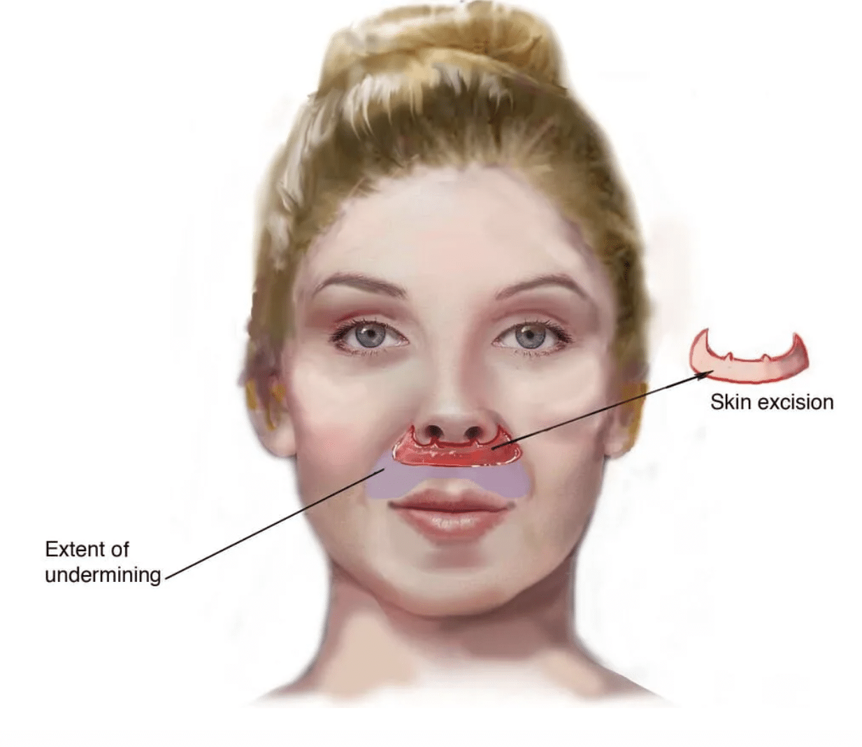 What Are The Different Types Of Lip Lifts? | Saxon MD