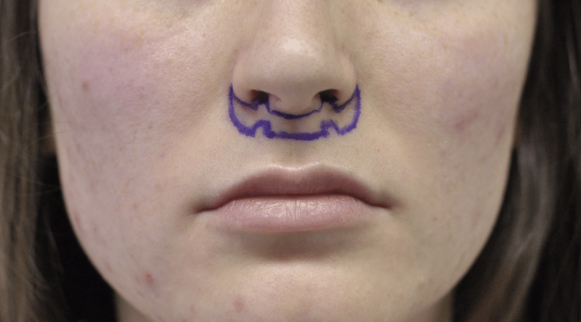 What Are The Different Types Of Lip Lifts? | Saxon MD