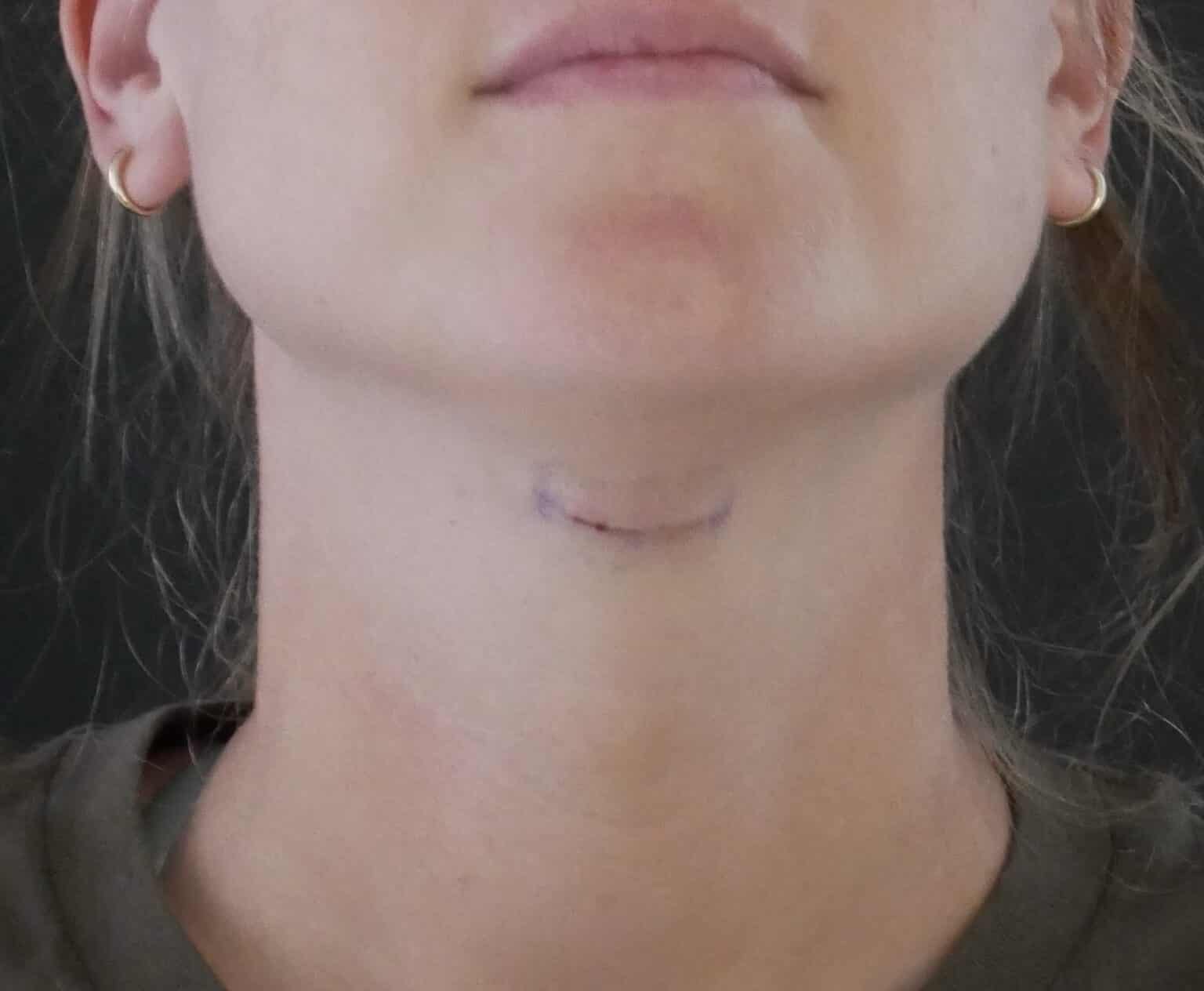 What Is Tracheal Shave Recovery Like?