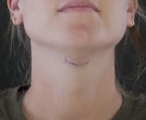 What Is Tracheal Shave Recovery Like?