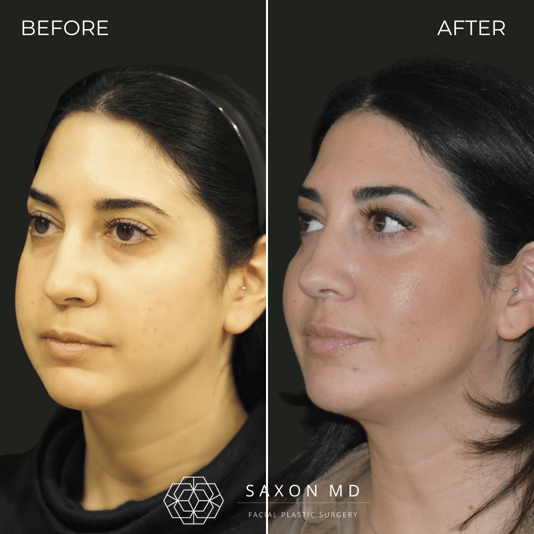 Buccal Fat Removal Before And After | Austin & Dallas, TX