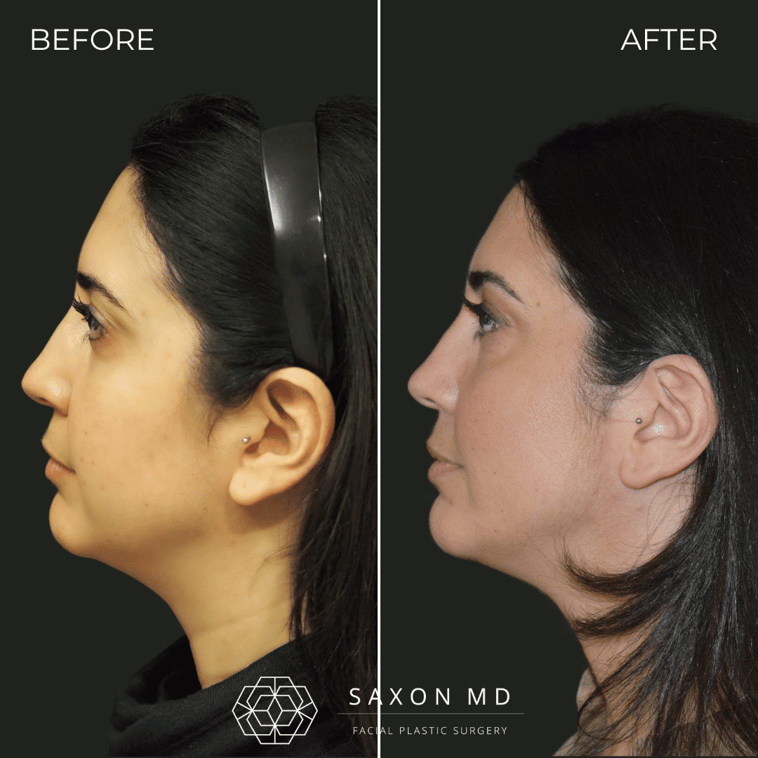Buccal Fat Removal Before And After | Austin & Dallas, TX