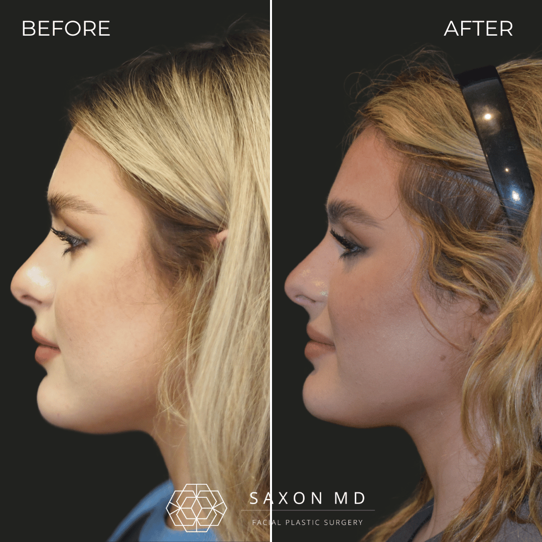 Buccal Fat Removal Before And After | Austin & Dallas, TX