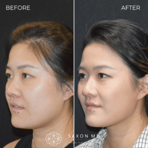Buccal Fat Removal Before And After | Austin & Dallas, TX
