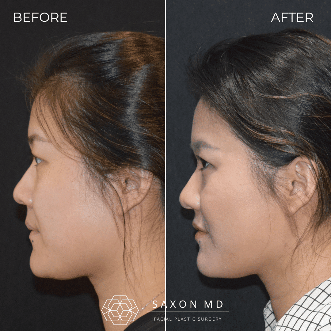 Buccal Fat Removal Before And After | Austin & Dallas, TX