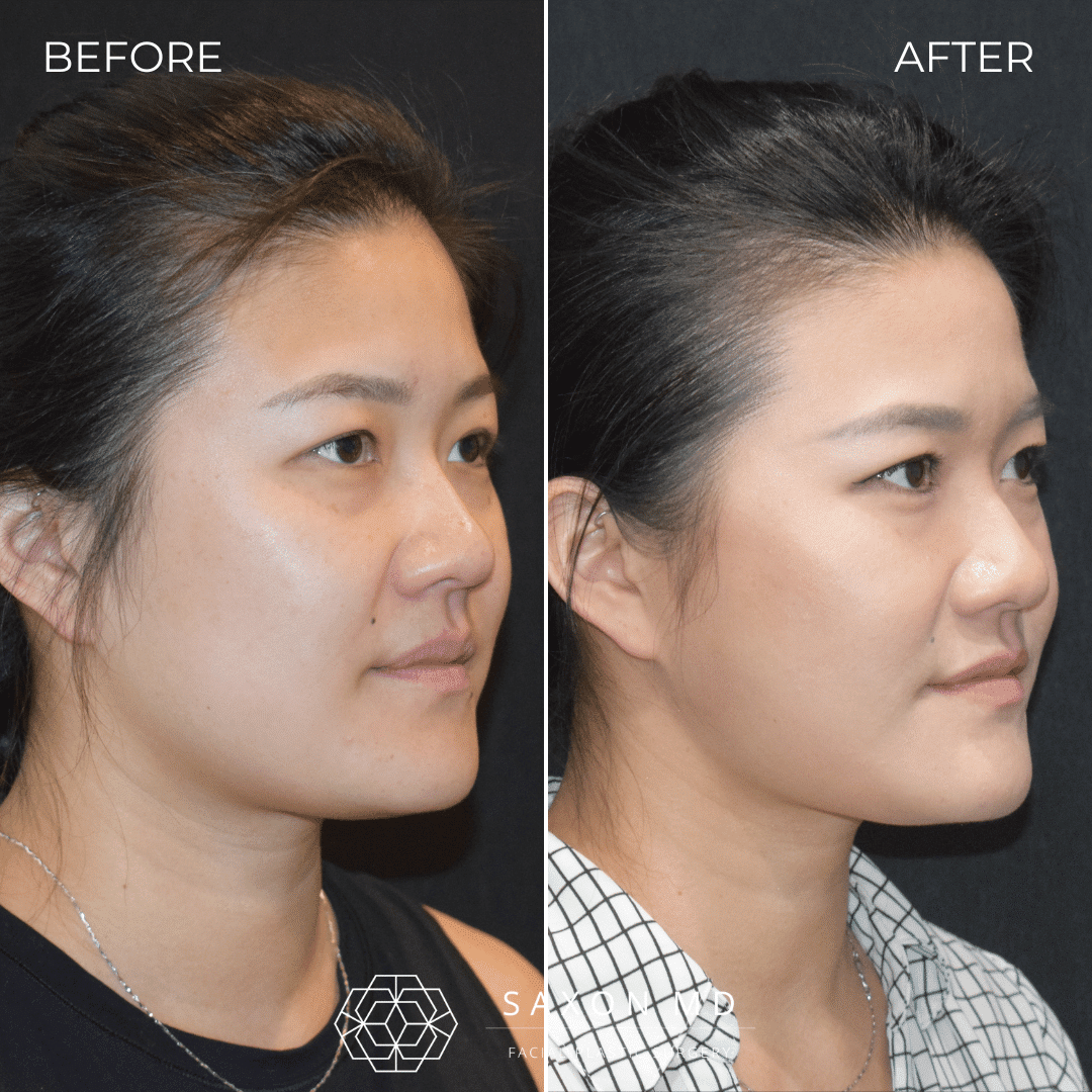 Buccal Fat Removal Before And After | Austin & Dallas, TX