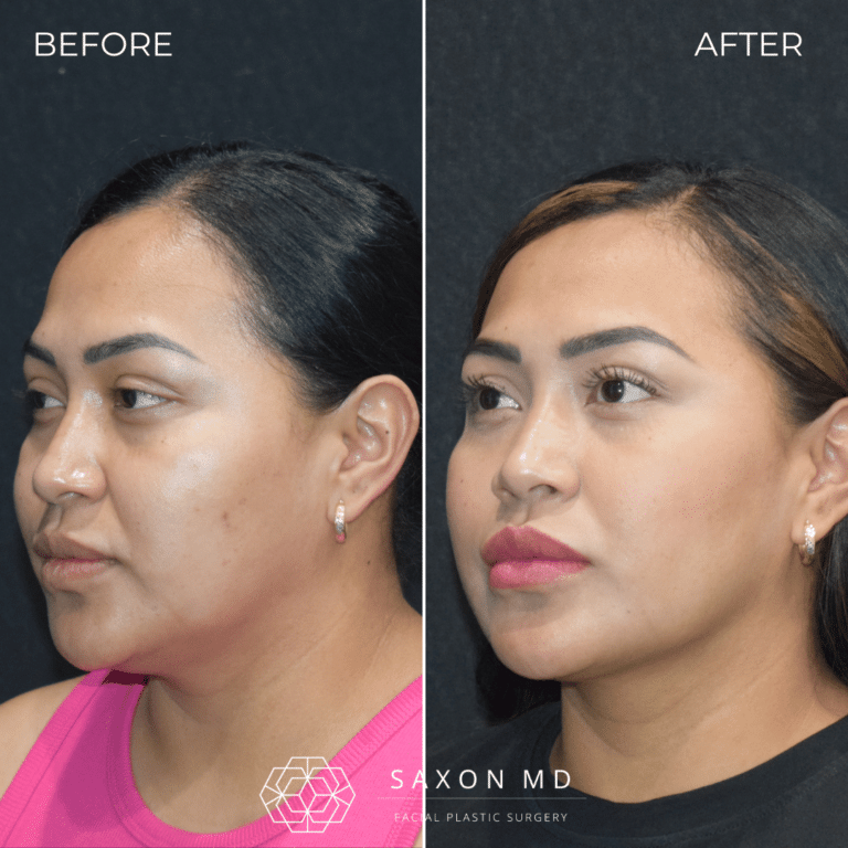 Buccal Fat Removal Before And After | Austin & Dallas, TX
