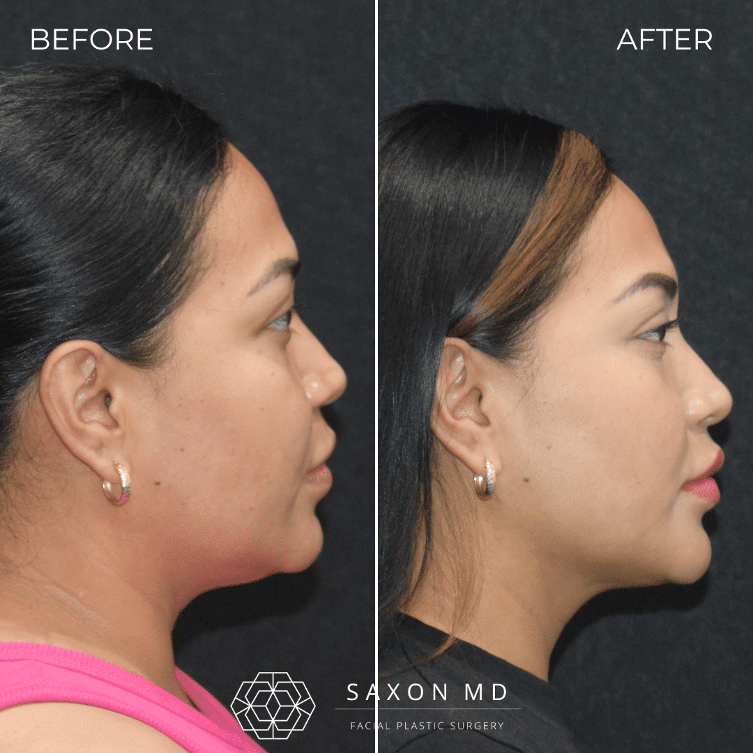 Buccal Fat Removal Before And After | Austin & Dallas, TX