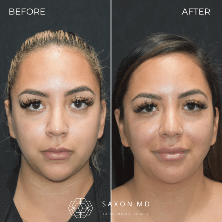 Buccal Fat Removal Before And After | Austin & Dallas, TX