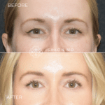 The Reason You Have Hooded Eyes (and What To Do About It)