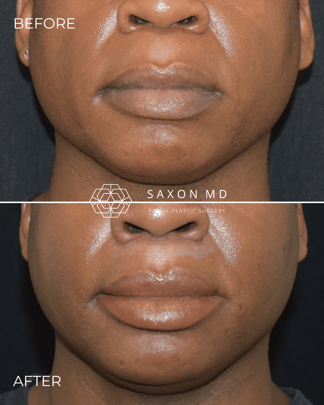 How Is A Male Lip Lift Different From A Lip Lift In A Woman?