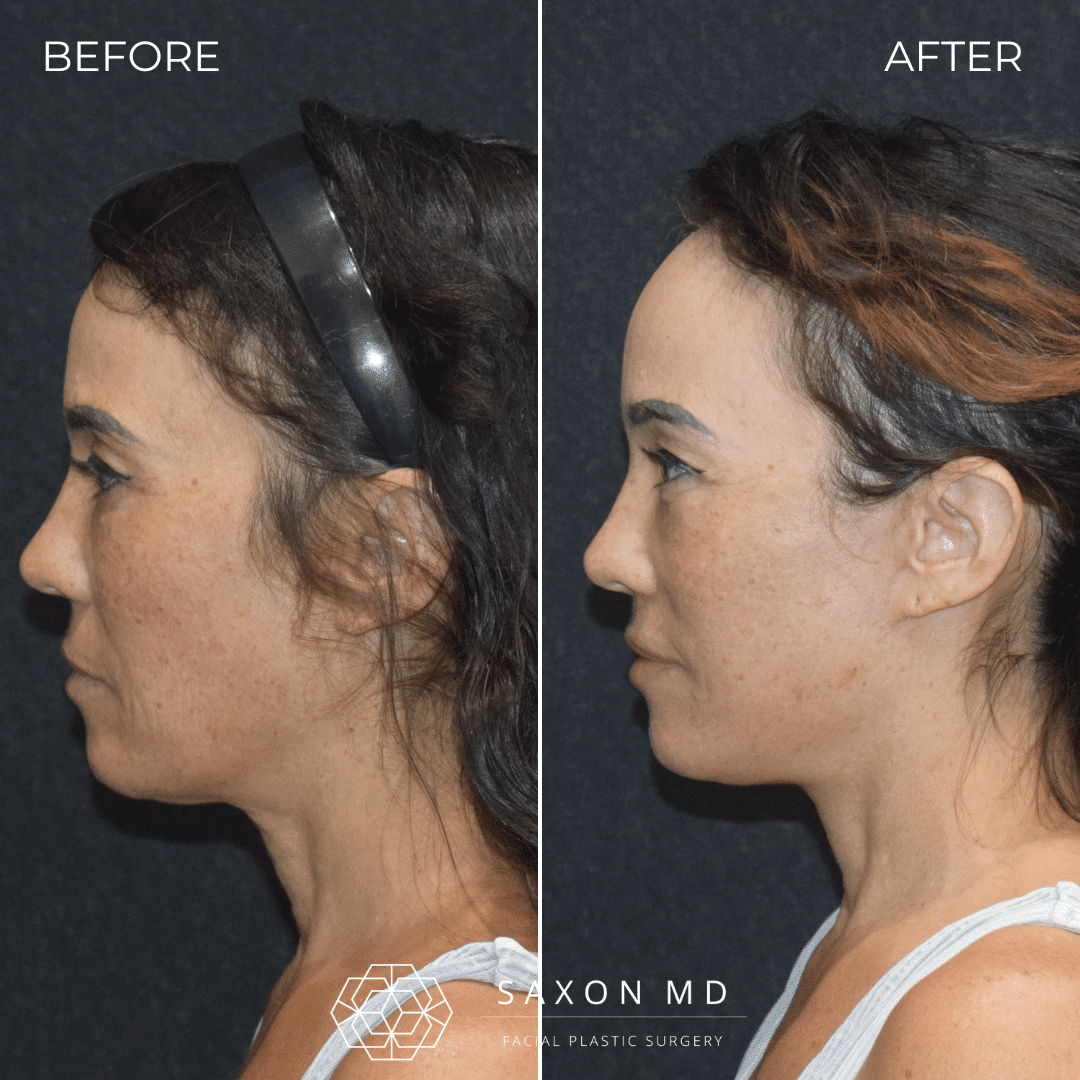 Deep Plane Facelift Before And After | Austin And Dallas, TX