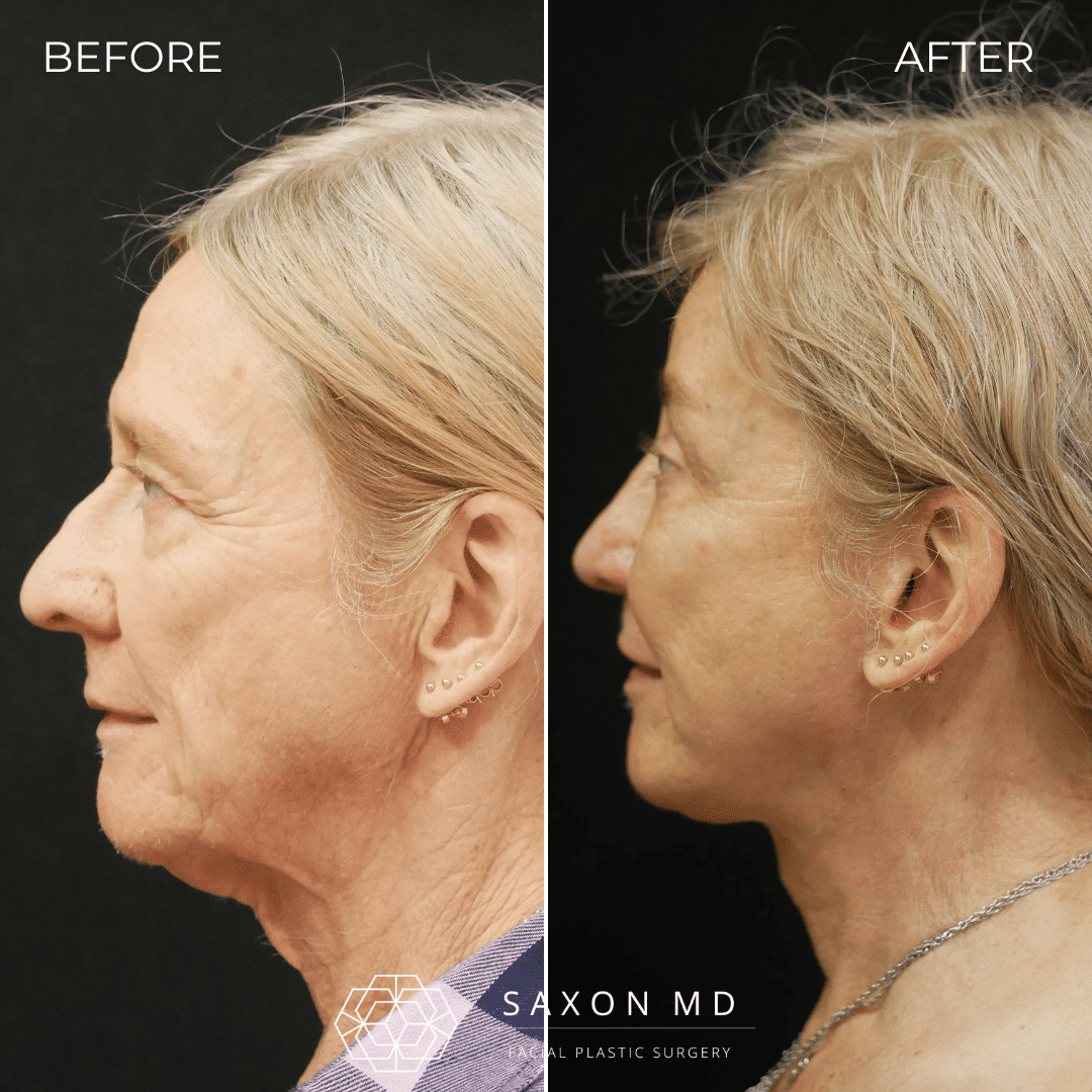 Deep Plane Facelift Before And After | Austin And Dallas, TX