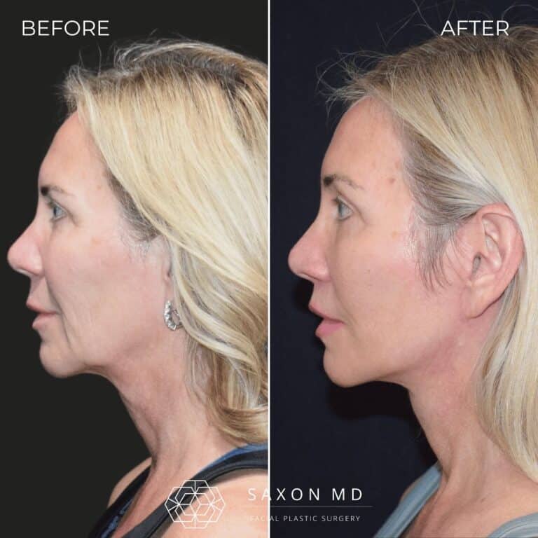 Deep Plane Facelift Before And After | Austin And Dallas, TX