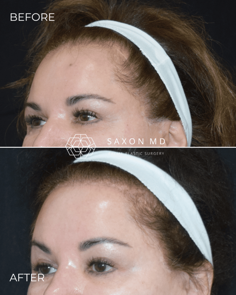 Brow Bone Reduction For Women With Frontal Bossing