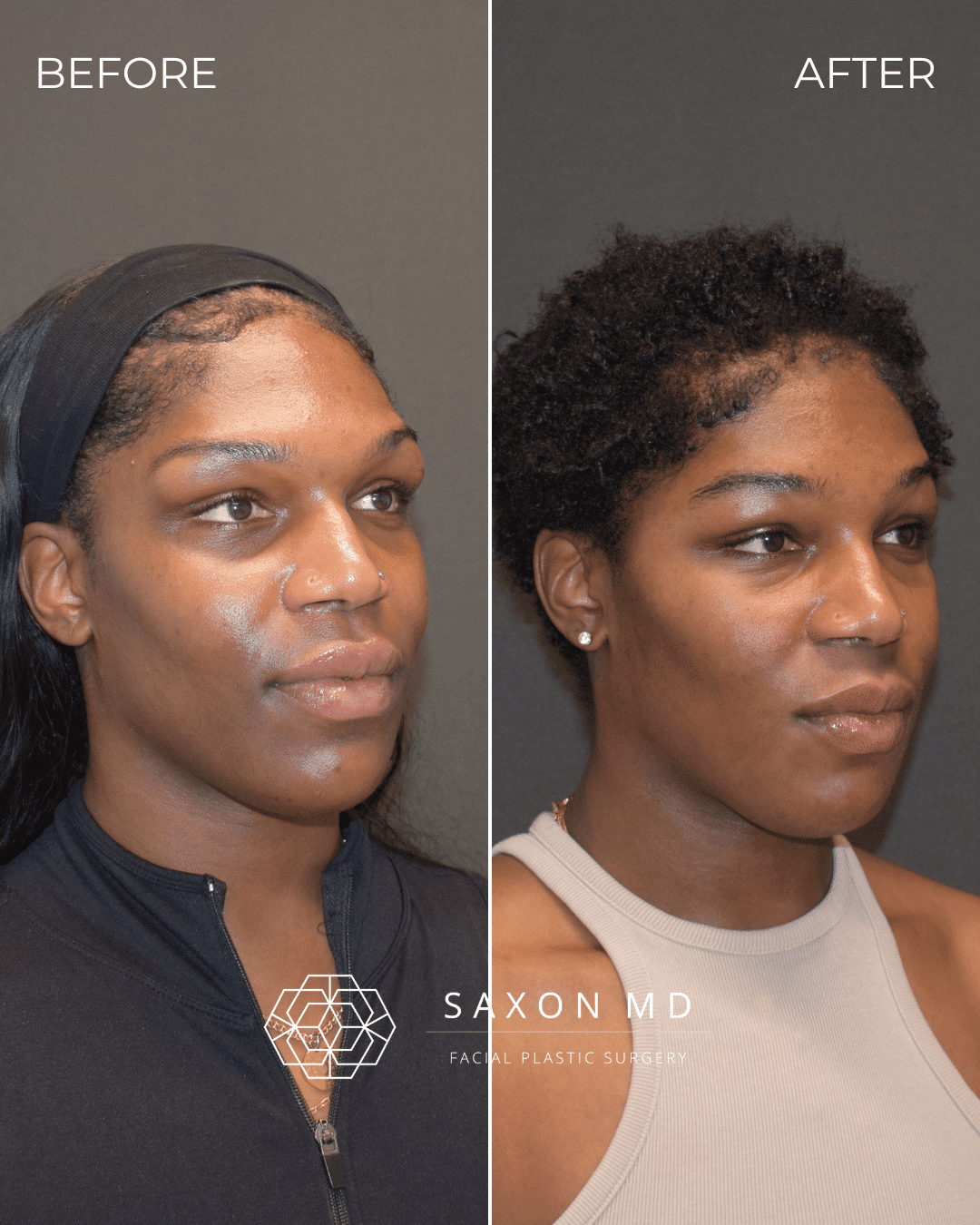 The Best Surgical Options To Reduce A Big Forehead