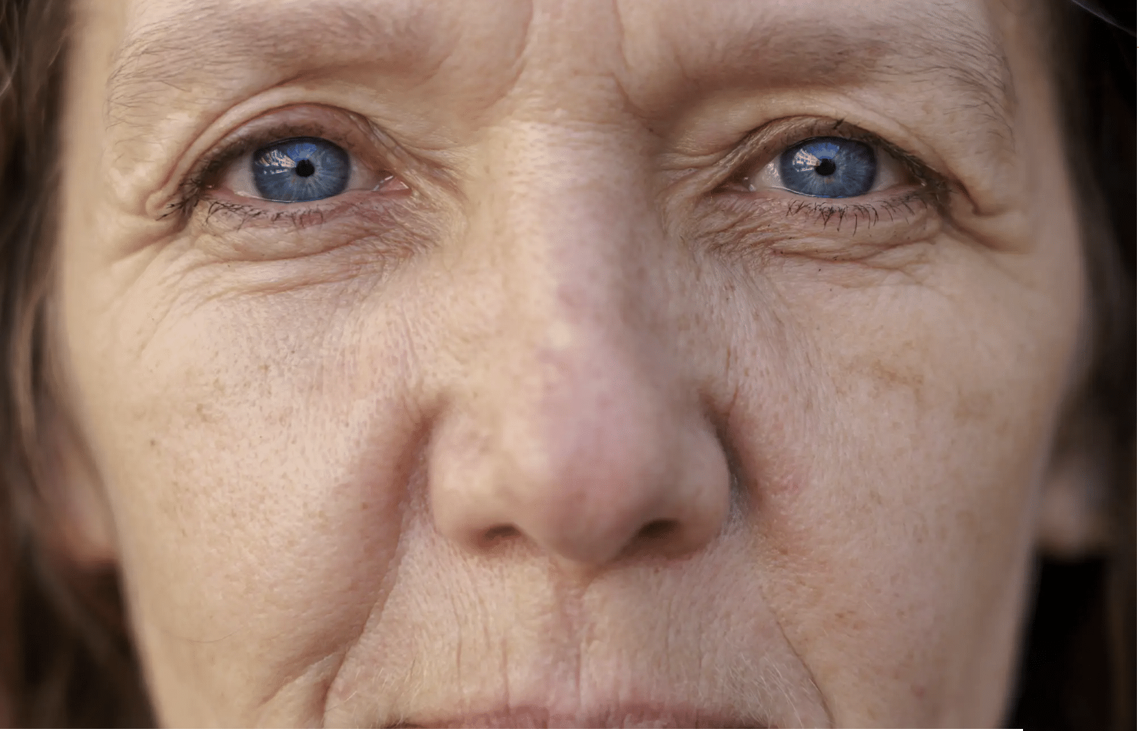 Fine Lines Vs Deep Rhytids: How To Treat Each Effectively