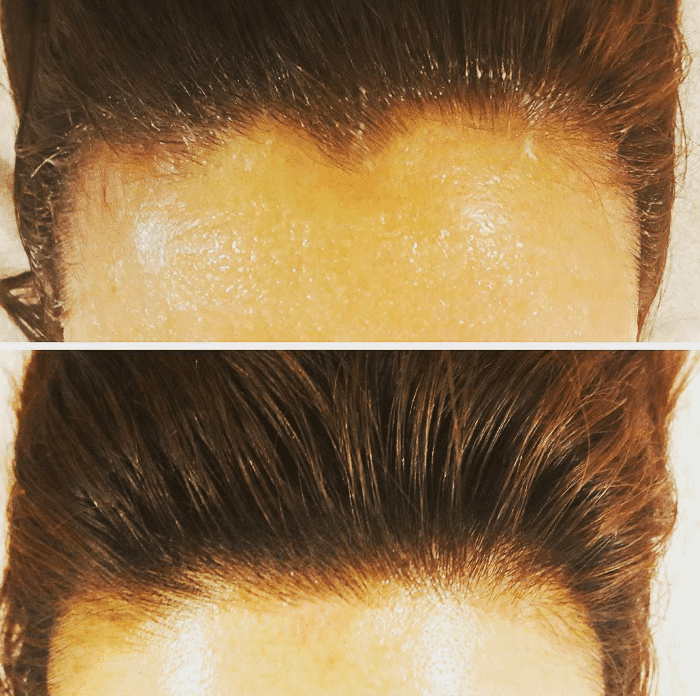 How To Get A Smaller Forehead | Dr. Sarah Saxon