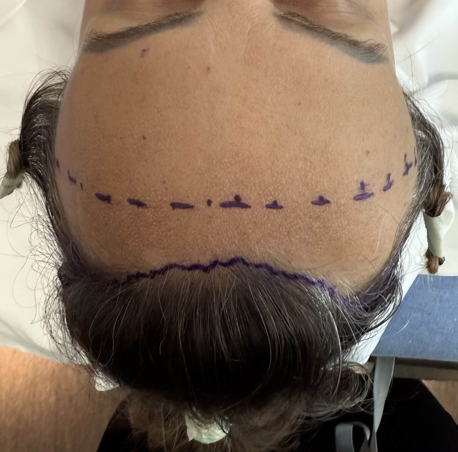 Can An M Shaped Hairline Be Reversed? Exploring Options