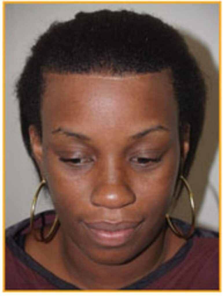 Why A Perfectly Straight Hairline Looks Fake