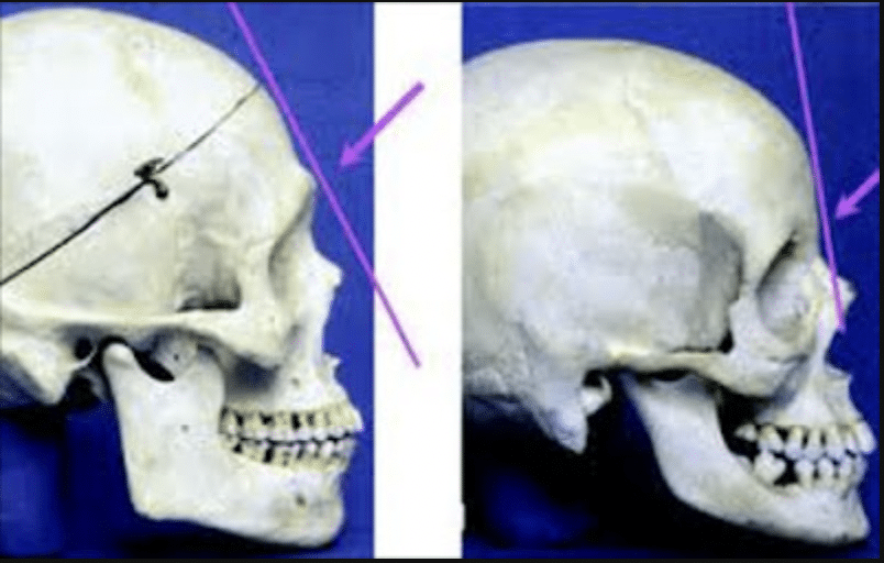 How To Reshape A Sloped Forehead | Dr. Sarah Saxon