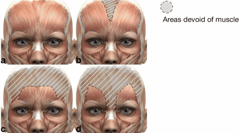 Understanding The Forehead Muscles: Preventing Brow Droop